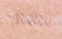 Atrofisch litteken | Oorzaak en behandeling | Sproet