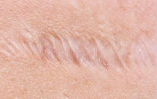 Atrofisch litteken | Oorzaak en behandeling | Sproet