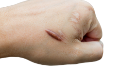 Atrofisch litteken | Oorzaak en behandeling | Sproet