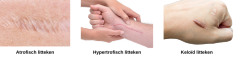 Littekens: hyperpigmentatie, atrofisch, hypertrofisch of keloïd