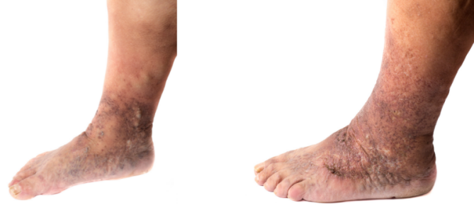 Rode plek op onderbeen | Oorzaak en oplossing | Sproet