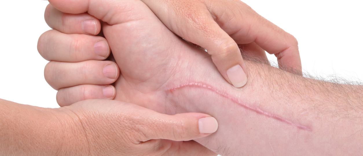 Hypertrofisch litteken | Oorzaak en behandelen | Sproet