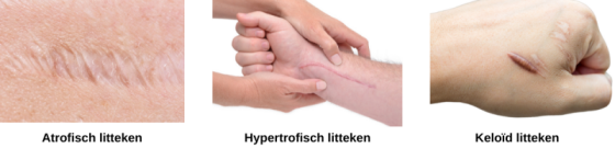 Hypertrofisch litteken | Oorzaak en behandelen | Sproet