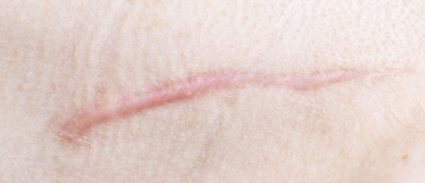 Hypertrofisch litteken | Oorzaak en behandelen | Sproet