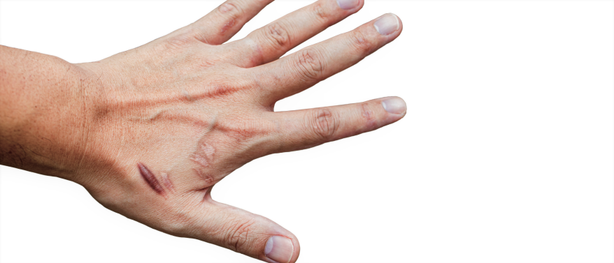 Atrofisch litteken | Oorzaak en behandeling | Sproet