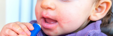 Liplik eczeem | Oorzaak en behandeling | Sproet