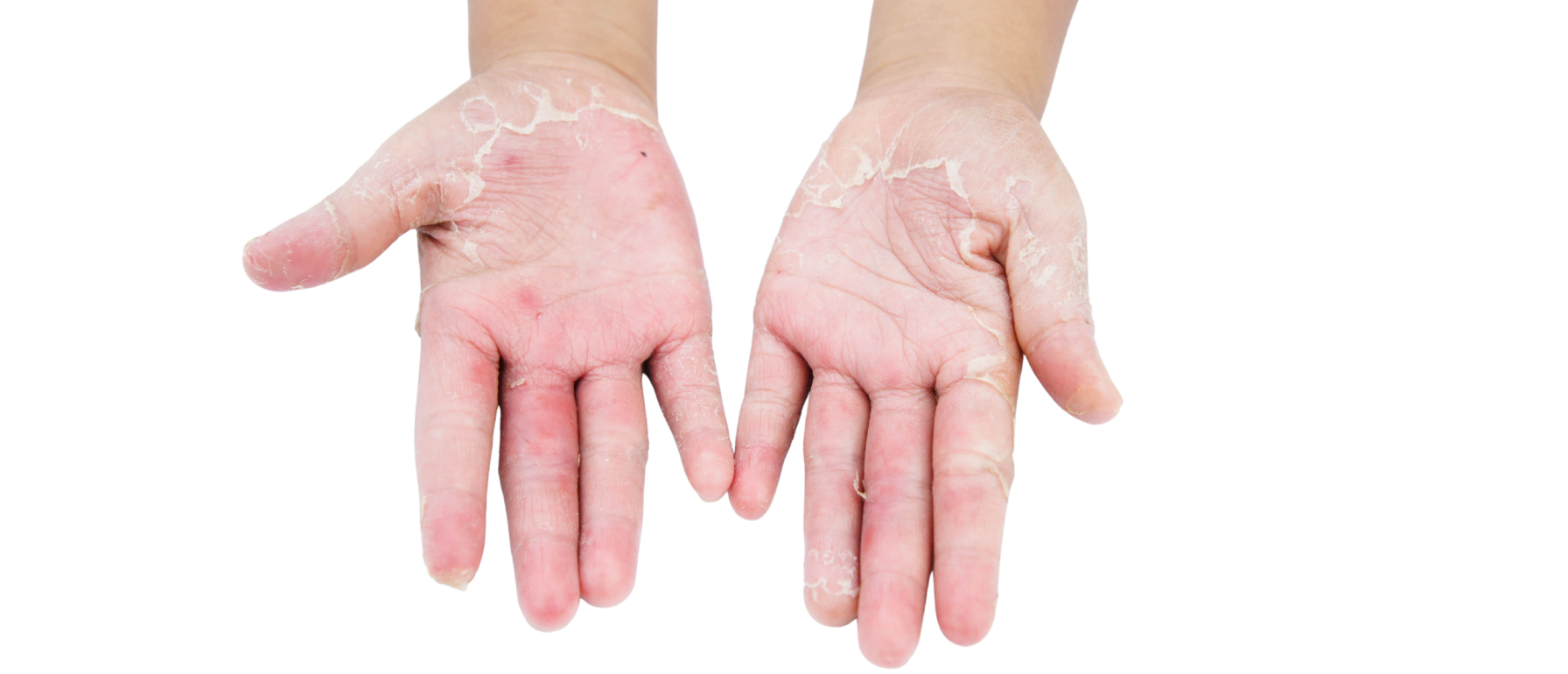 Handschimmel | Oplossing en behandeling | Sproet