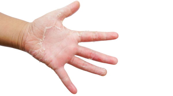 Handschimmel | Oplossing en behandeling | Sproet