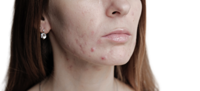 Acne bij volwassenen | Wat te doen? | Sproet