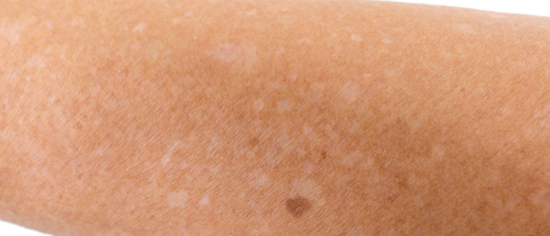 Confettihuid | Oorzaak en is er een oplossing? | Sproet