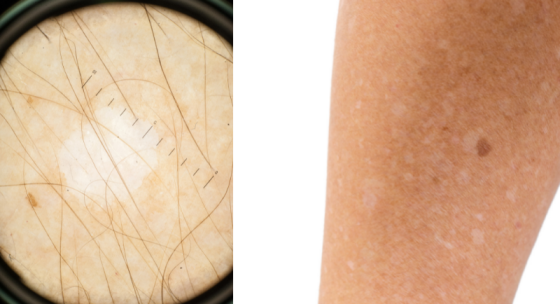 Confettihuid | Oorzaak en is er een oplossing? | Sproet