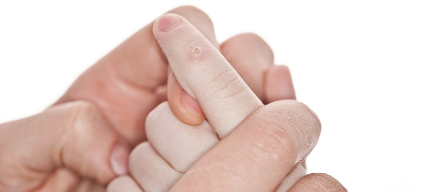 Wrat | Oorzaak en behandeling | Sproet