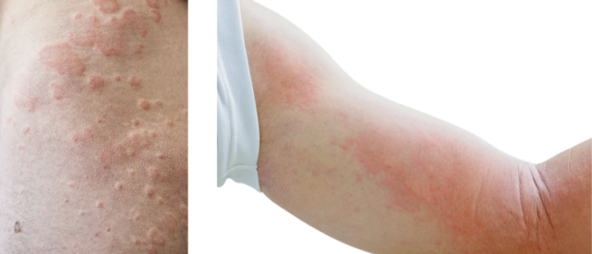 Huid allergieën | Oorzaak en tips | Sproet