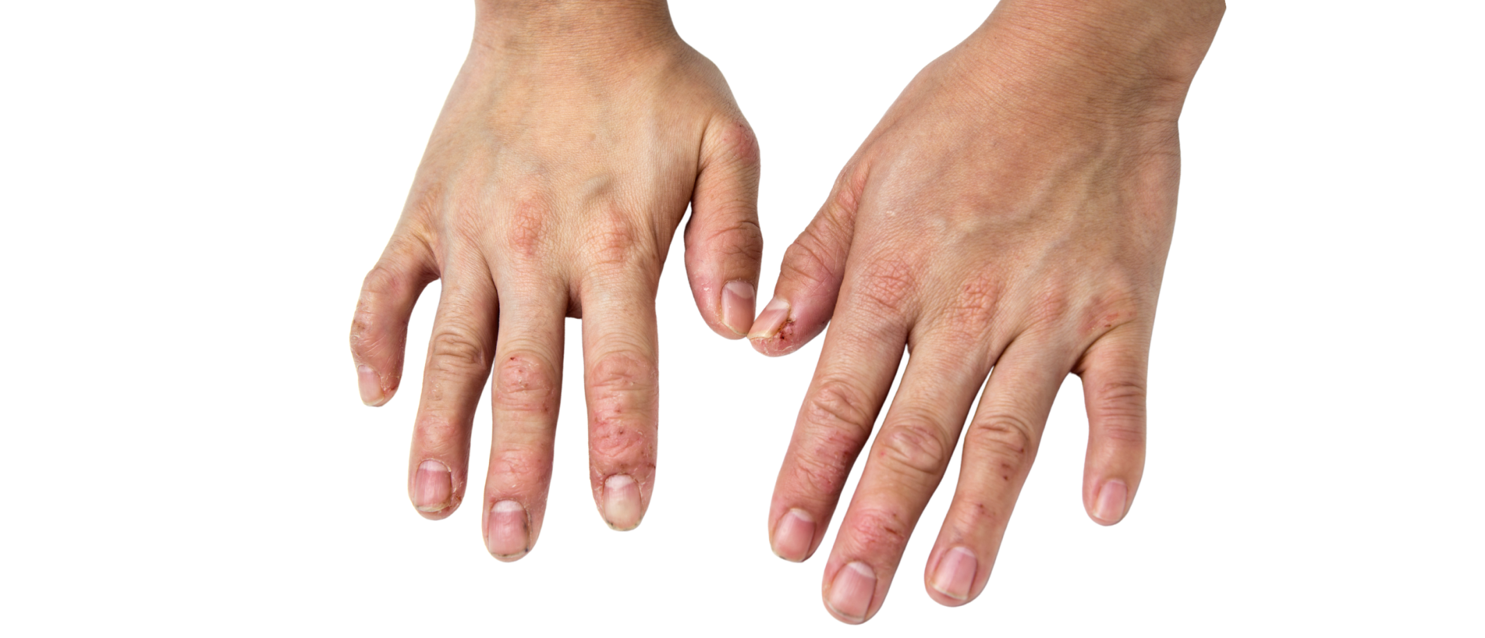 Blaasjeseczeem | Oorzaak en tips | Sproet