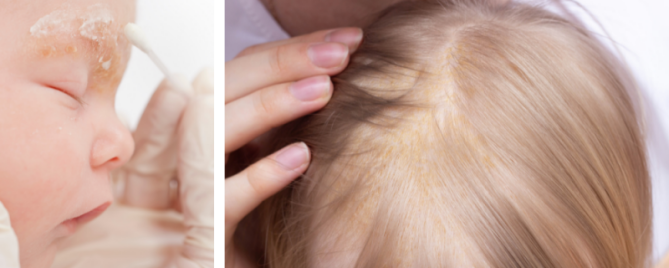 Soorten eczeem | Oorzaak en tips | Sproet