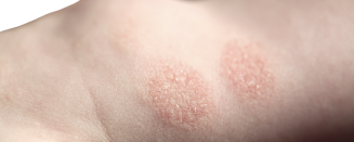 Soorten eczeem | Oorzaak en tips | Sproet