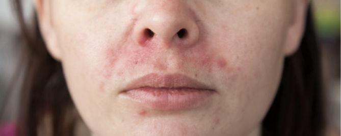 Soorten eczeem | Oorzaak en tips | Sproet