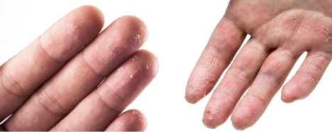 Soorten eczeem | Oorzaak en tips | Sproet