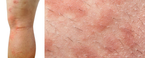 Soorten eczeem | Oorzaak en tips | Sproet