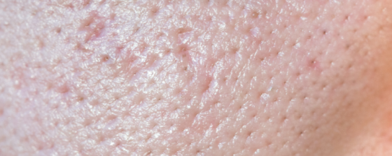 Vette huid gezicht | Oorzaak en oplossing | Sproet