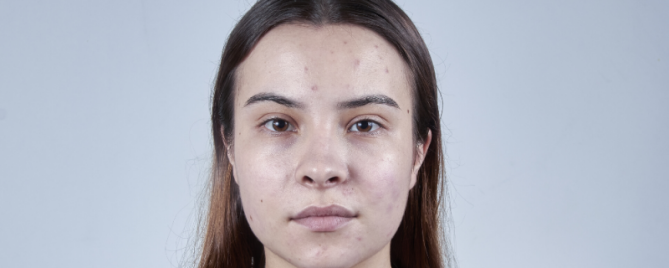 Vette huid gezicht | Oorzaak en oplossing | Sproet