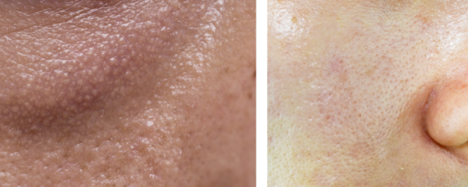 Vette huid gezicht | Oorzaak en oplossing | Sproet