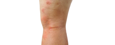 Atopisch eczeem | Oorzaak en tips | Sproet