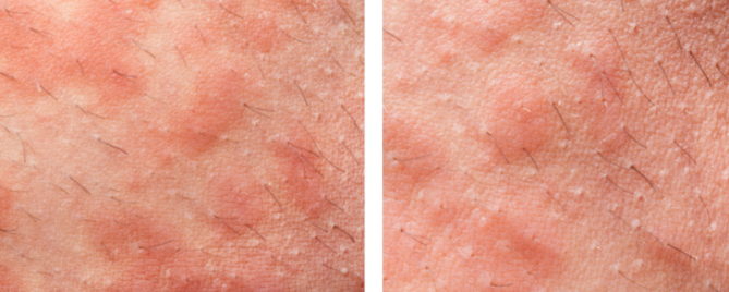 Atopisch eczeem | Oorzaak en tips | Sproet