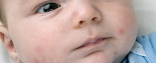 Baby acne | Oorzaak en tips | Sproet