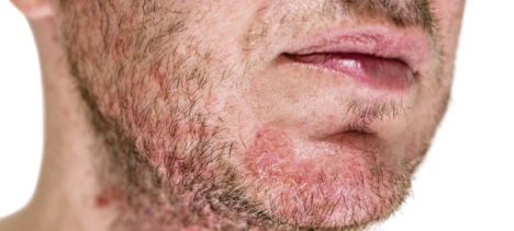 Seborroïsch eczeem | Mijn tips als huidtherapeut!