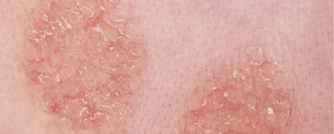 Nummulair eczeem | Schilferende, ronde, rode vlekken | Sproet