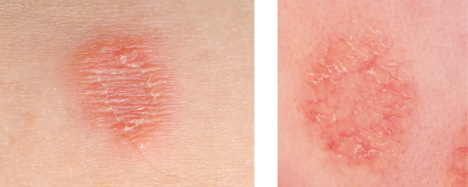 Nummulair eczeem | Schilferende, ronde, rode vlekken | Sproet