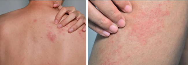 Jeuk en uitslag na zwemmen in chloor | Oplossing | Sproet