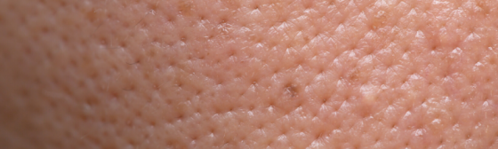 Grove poriën | Mijn tips als huidtherapeut