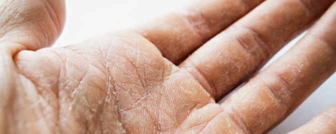 Droge handen | Oorzaak en Oplossing | Sproet