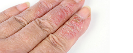 Droge handen | Oorzaak en Oplossing | Sproet