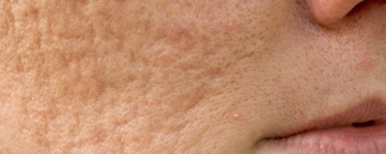 Littekens: hyperpigmentatie, atrofisch, hypertrofisch of keloïd