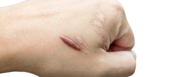 Littekens: hyperpigmentatie, atrofisch, hypertrofisch of keloïd