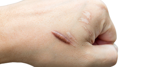 Littekens: hyperpigmentatie, atrofisch, hypertrofisch of keloïd