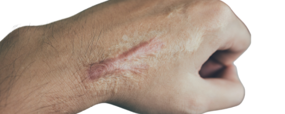 Littekens: hyperpigmentatie, atrofisch, hypertrofisch of keloïd