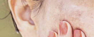 Littekens: hyperpigmentatie, atrofisch, hypertrofisch of keloïd