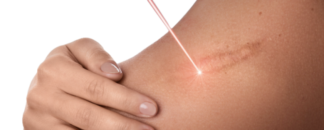 Littekens: hyperpigmentatie, atrofisch, hypertrofisch of keloïd