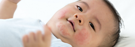 Atopisch eczeem | Oorzaak en tips | Sproet