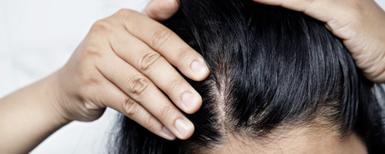 Glimmend, vet haar | Oorzaak en tips | Sproet
