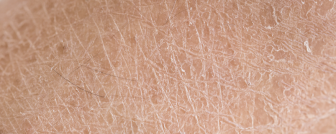 Een droge huid | Oorzaak en tips | Sproet