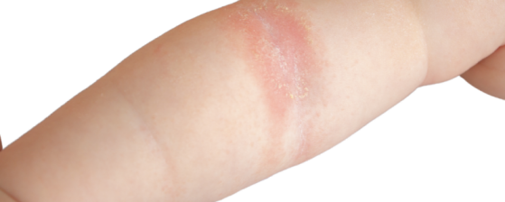 Intertrigo: smetplekken onder de plooien