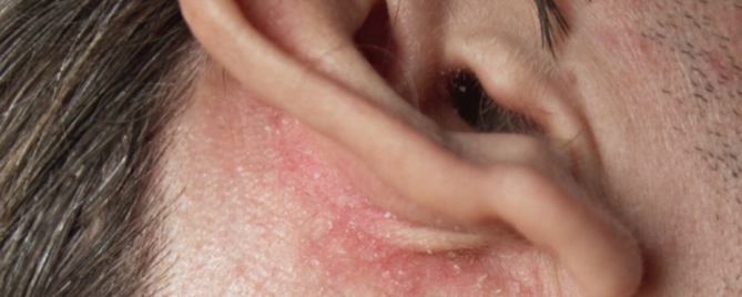 Intertrigo: smetplekken onder de plooien