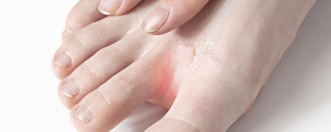 Intertrigo: smetplekken onder de plooien