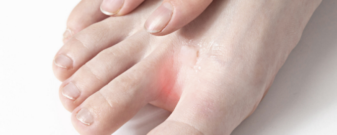 Intertrigo: smetplekken onder de plooien