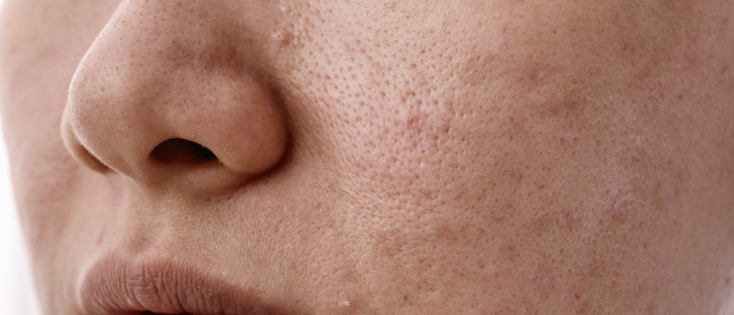 Acne comedonica: mee-eters | Oorzaak en tips | Sproet